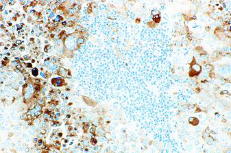 Melanoma Marker (HMB45) - IHC Primary Antibodies